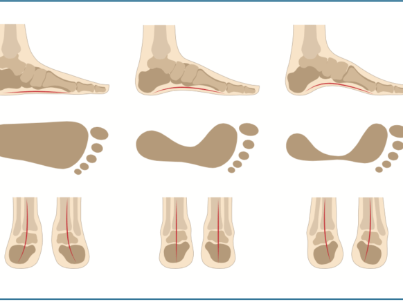 Design Modifications for Functional Foot Orthotics - Hersco Edu Center