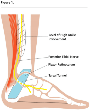 Tarsal Tunnel Syndrome - Hersco Edu Center